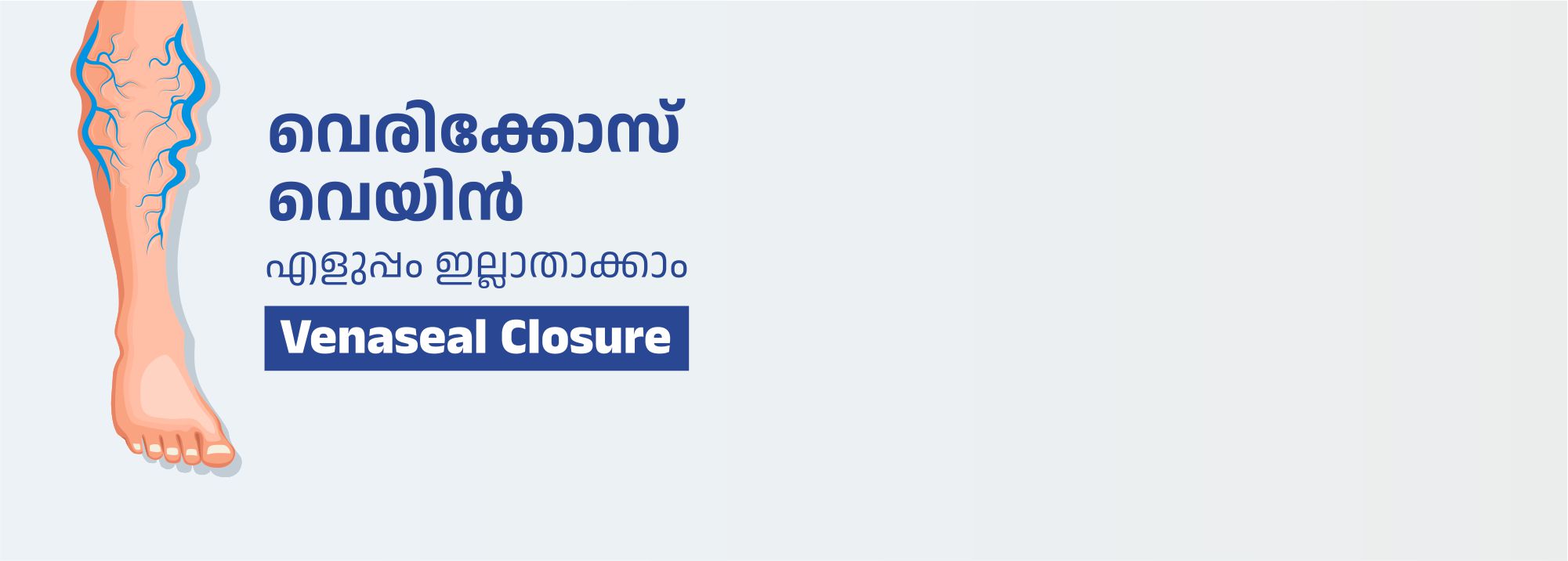Varicose Vein Treatment in Kochi | Aster Medcity Interventional Radiology