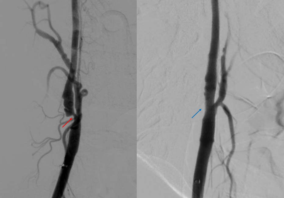 Carotid Stenting | Aster