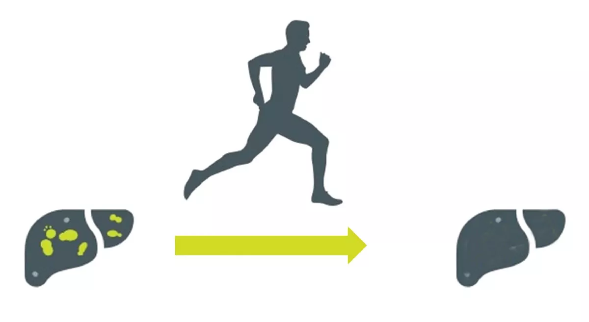 Move for a Healthy Liver: How Physical Activity Can Combat Fatty Liver ...
