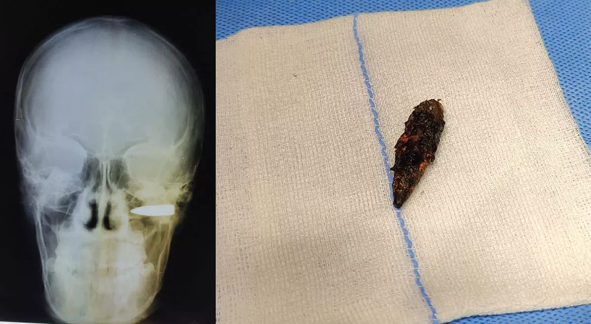 Bullet Removed from Ear in Complex Surgery in Bangalore | Aster RV