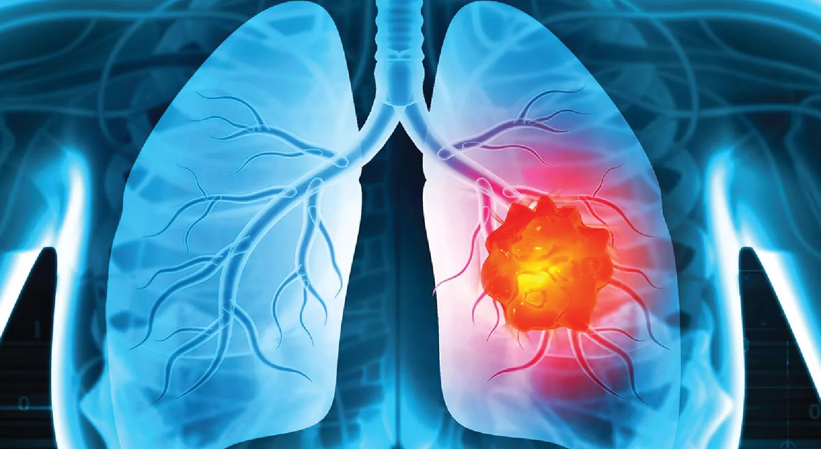 Bronchial Asthma Treatments, Symptoms, Causes, and More