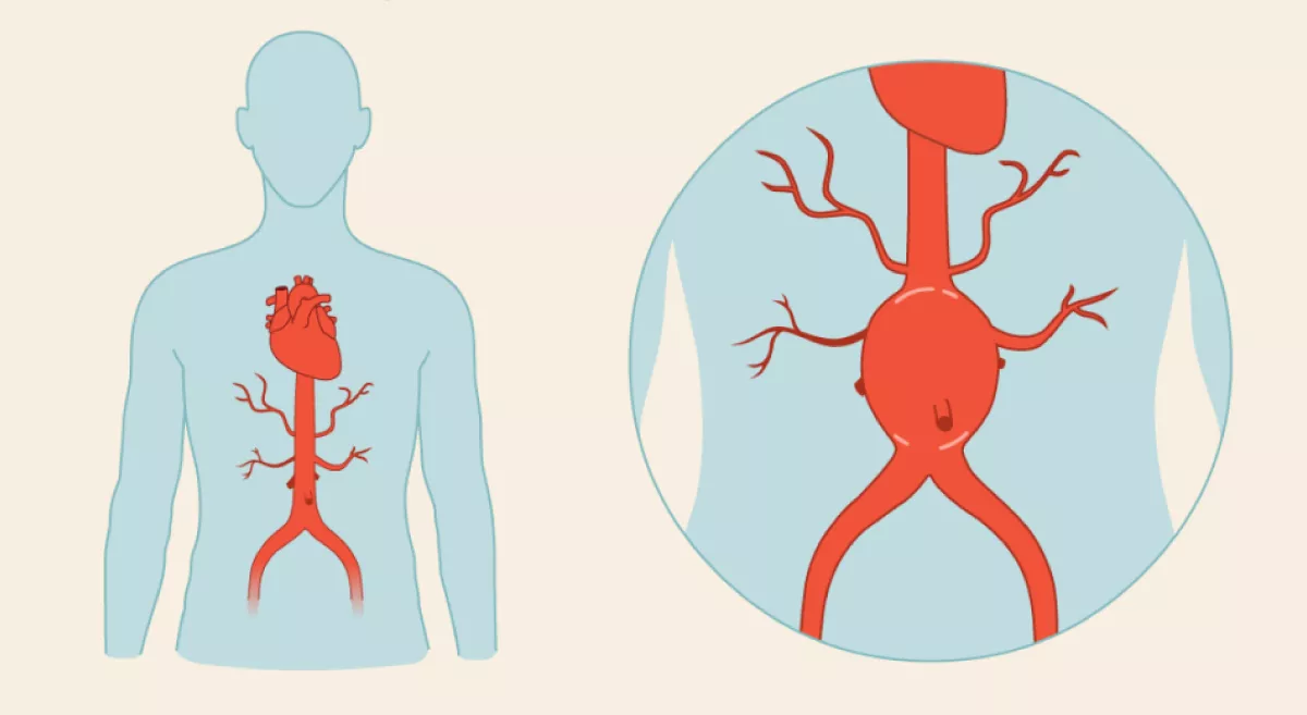 Peripheral Vascular Disease – Aortoiliac Occlusive Disease | Aster